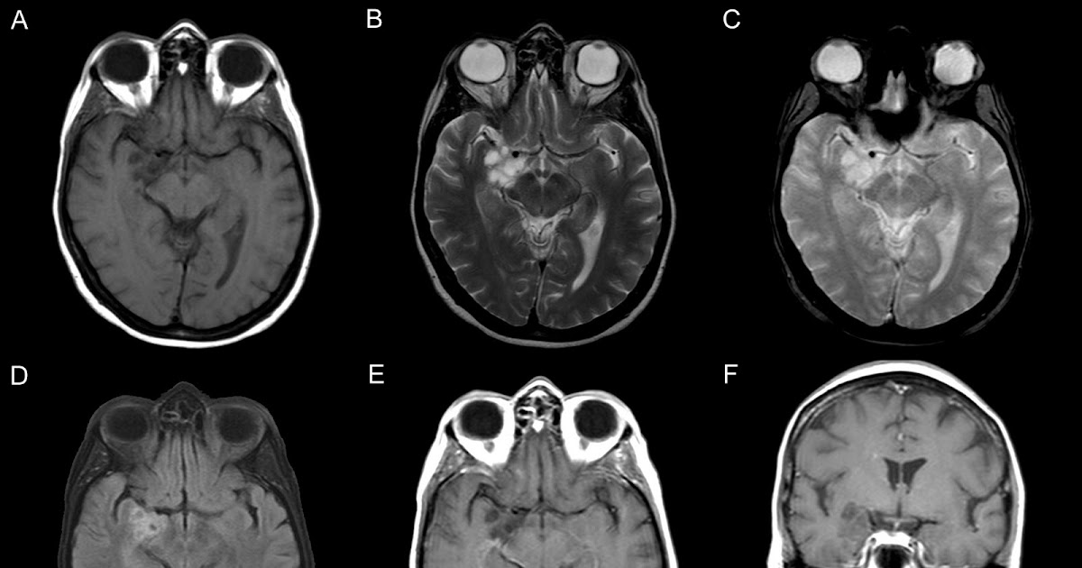 Roentgen Ray Reader: Dysembryoplastic Neuroepithelial Tumor (DNET)