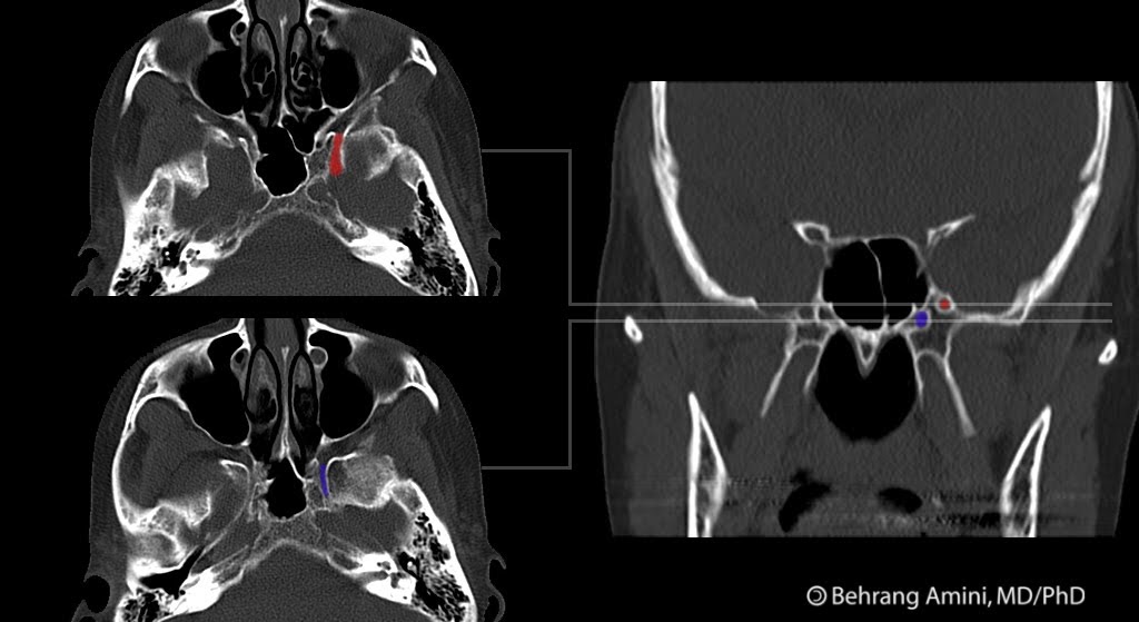 Foramen Rotundum Xray