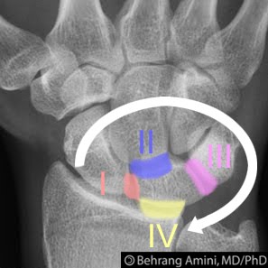 Roentgen Ray Reader: Mayfield Perilunate Instability Pattern