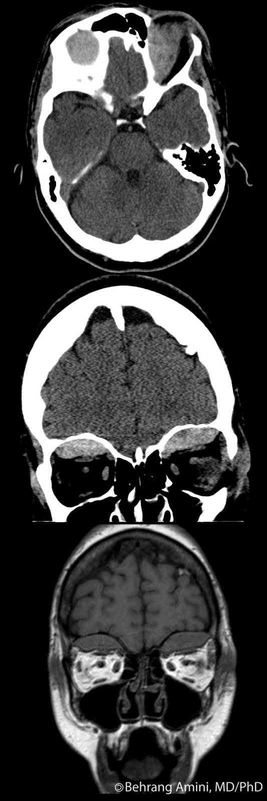 Roentgen Ray Reader: Subperiosteal Orbital Hemorrhage