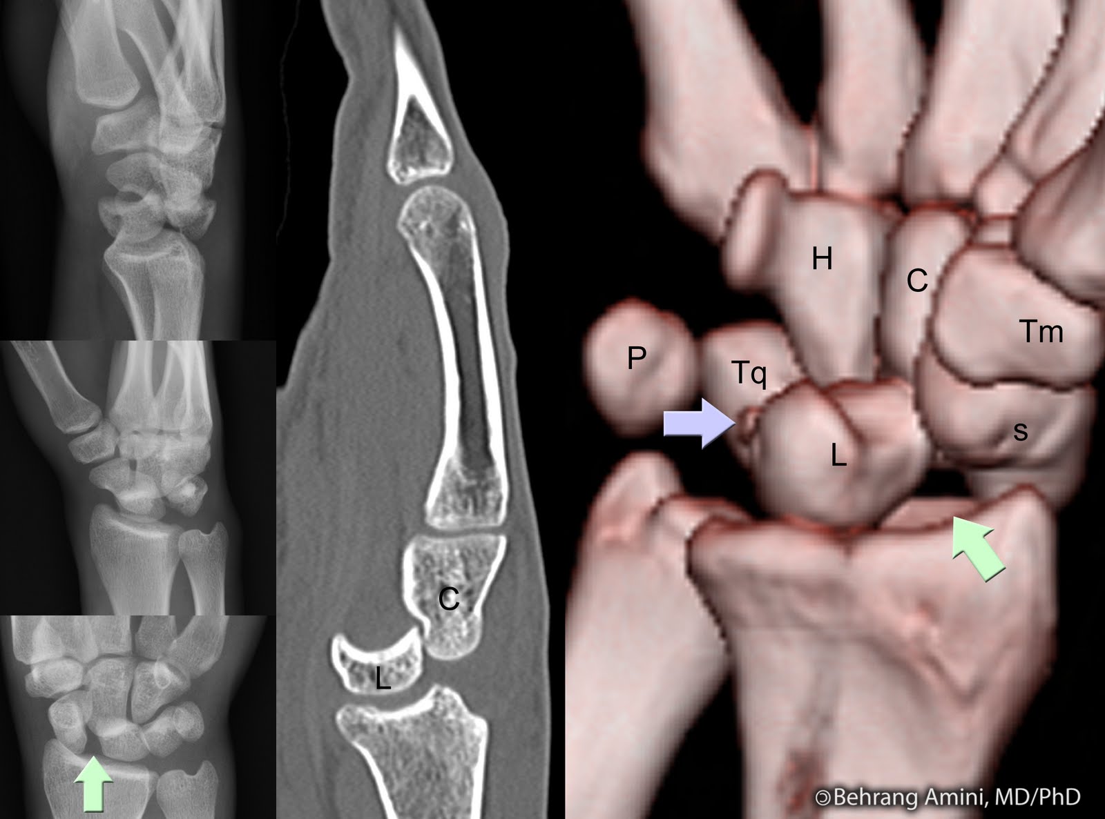 Roentgen Ray Reader: Perilunate Dislocation