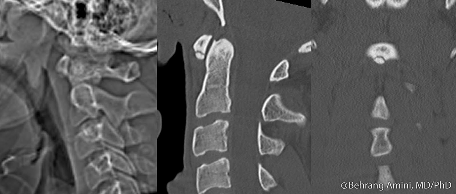 Roentgen Ray Reader: Inferior Accessory Ossicle of the Anterior Arch of C1