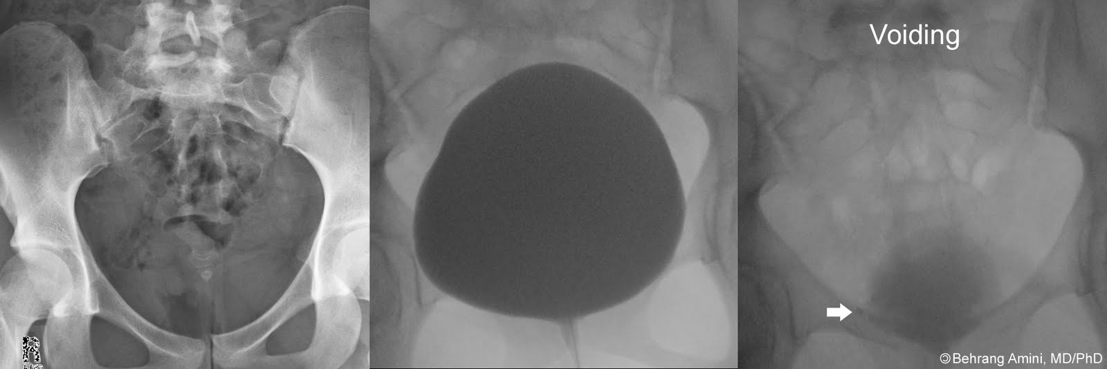 Roentgen Ray Reader: Infrequent Voiding Syndrome