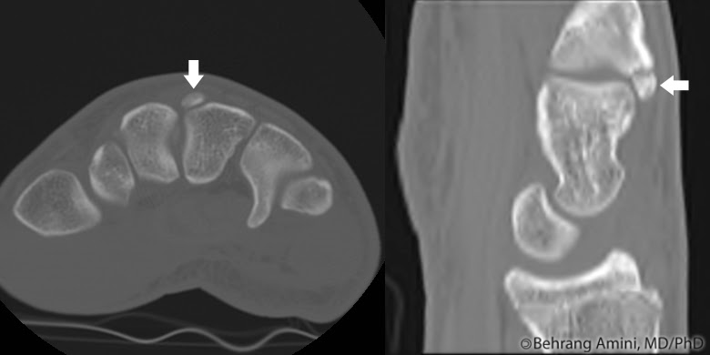 Roentgen Ray Reader: Carpal Boss