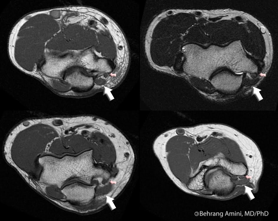 Anconeus Epitrochlearis Muscle