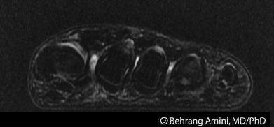 Roentgen Ray Reader: Intermetatarsal Bursitis