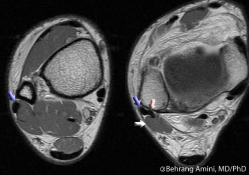 Peroneus Quartus Mri