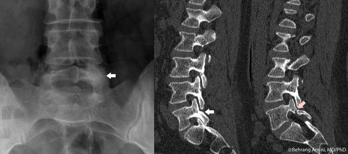 Roentgen Ray Reader Unilateral Dense Pedicle