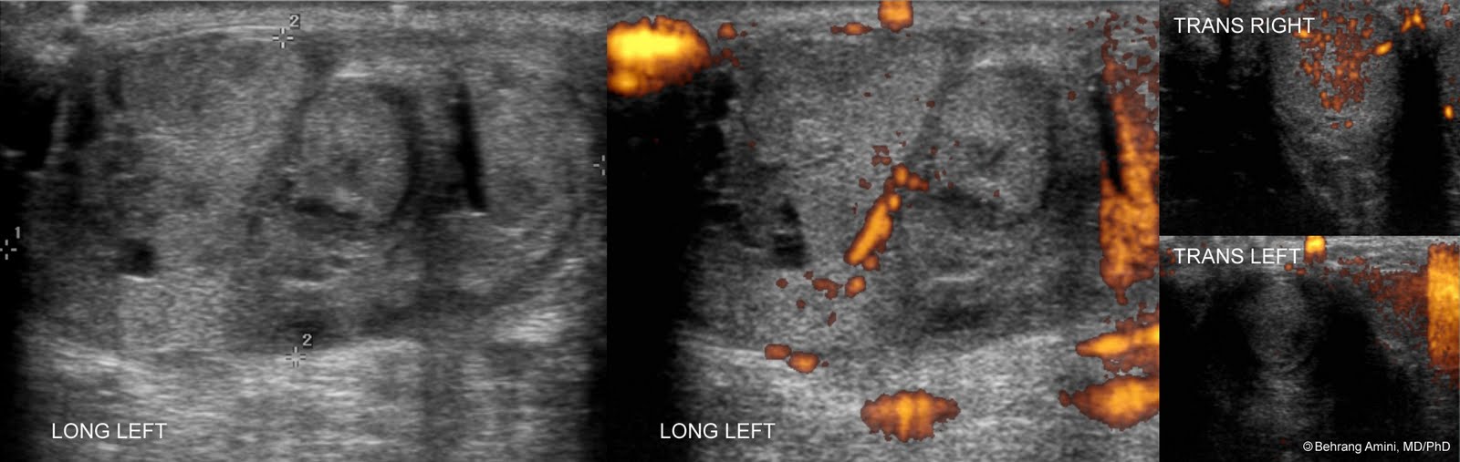 Testicular Rupture Ultrasound