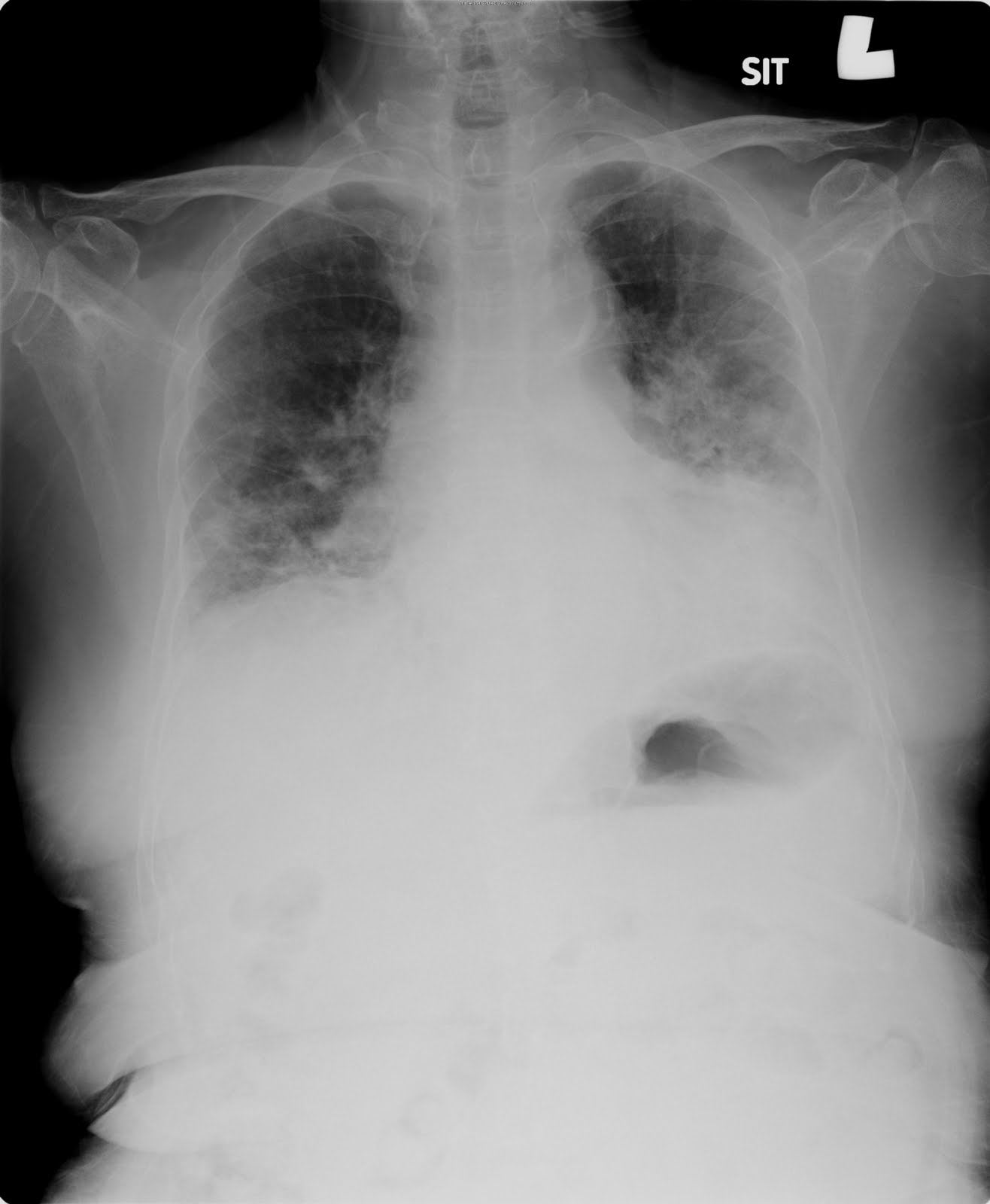 CXR 胸部x光判讀 idiopathic pulmonary fibrosis