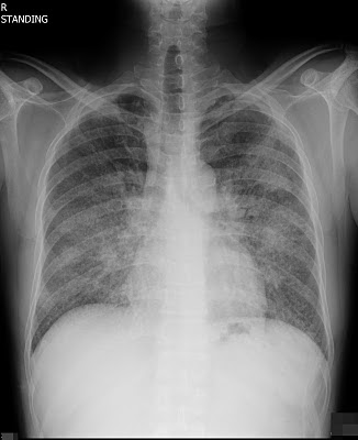 CXR 胸部x光判讀 Pulmonary alveolar proteinosis (PAP)