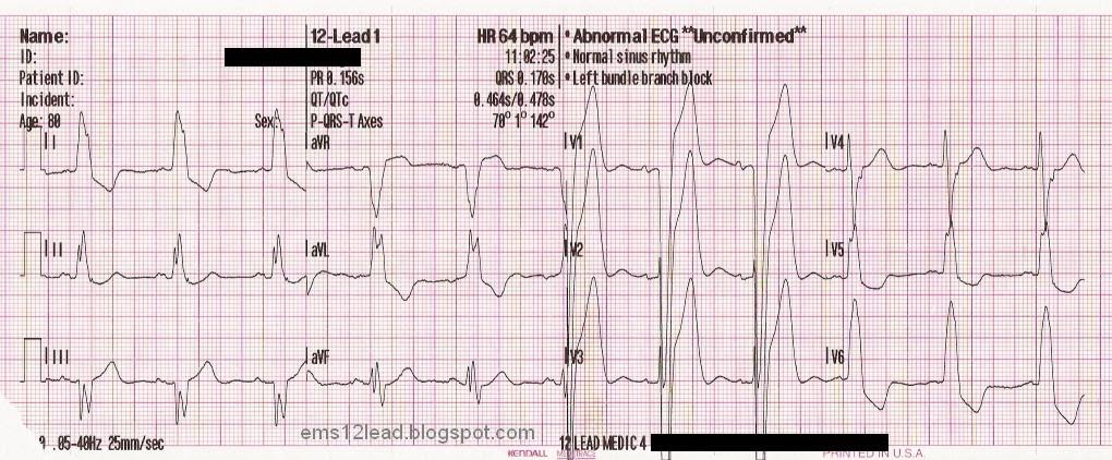 Discordant ST-Segment Elevation in LBBB or Paced Rhythm | Paramedicine 101