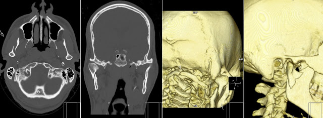 Subcondylar Mandibula Fracture - Radiology Imaging