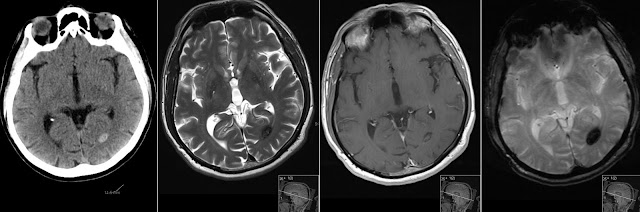 Cavernoma - Cavernous Angioma