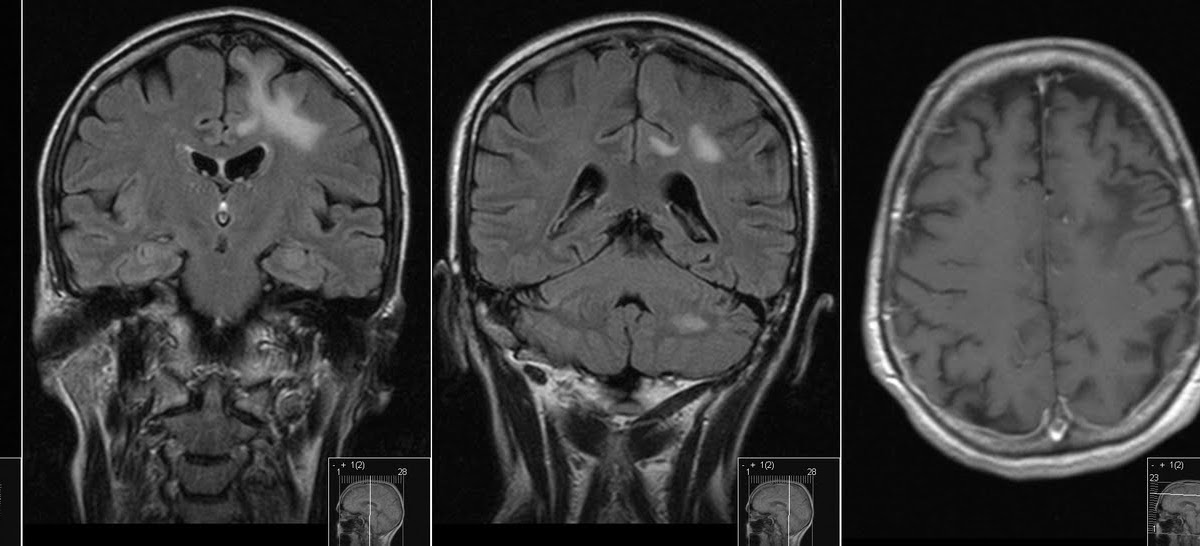 Progressive Multifocal Leukoencephalopathy - PML