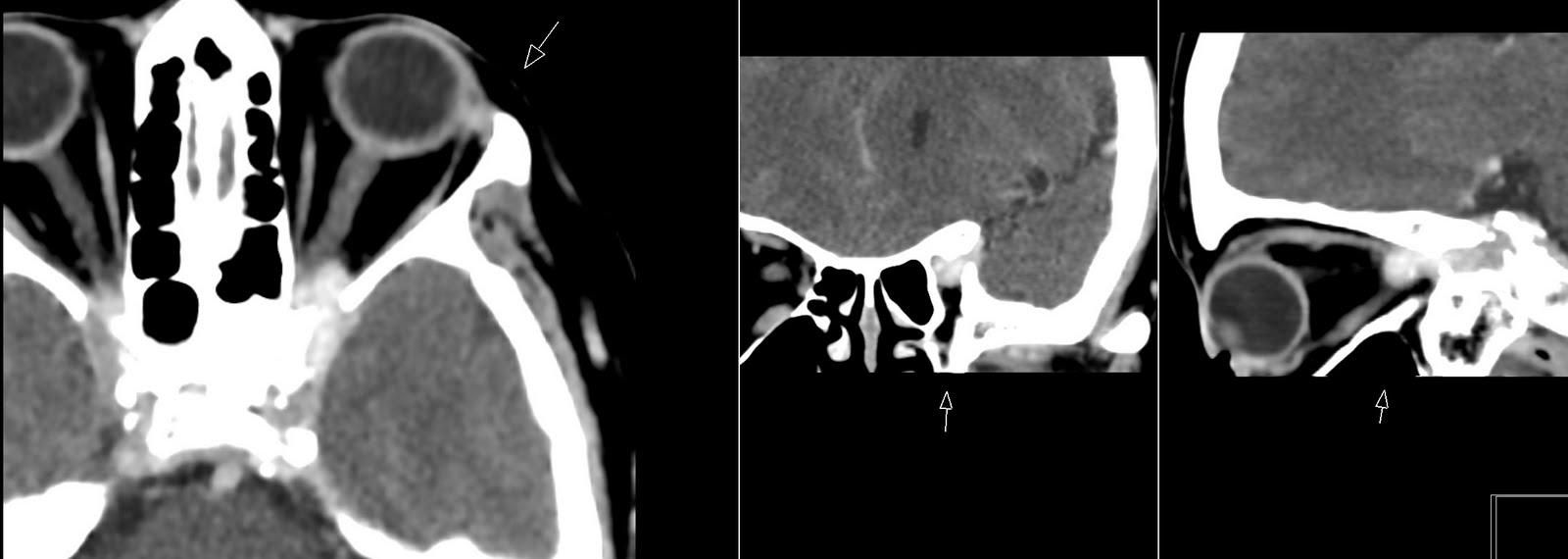 Radiology MRI: Tolosa-Hunt Syndrome