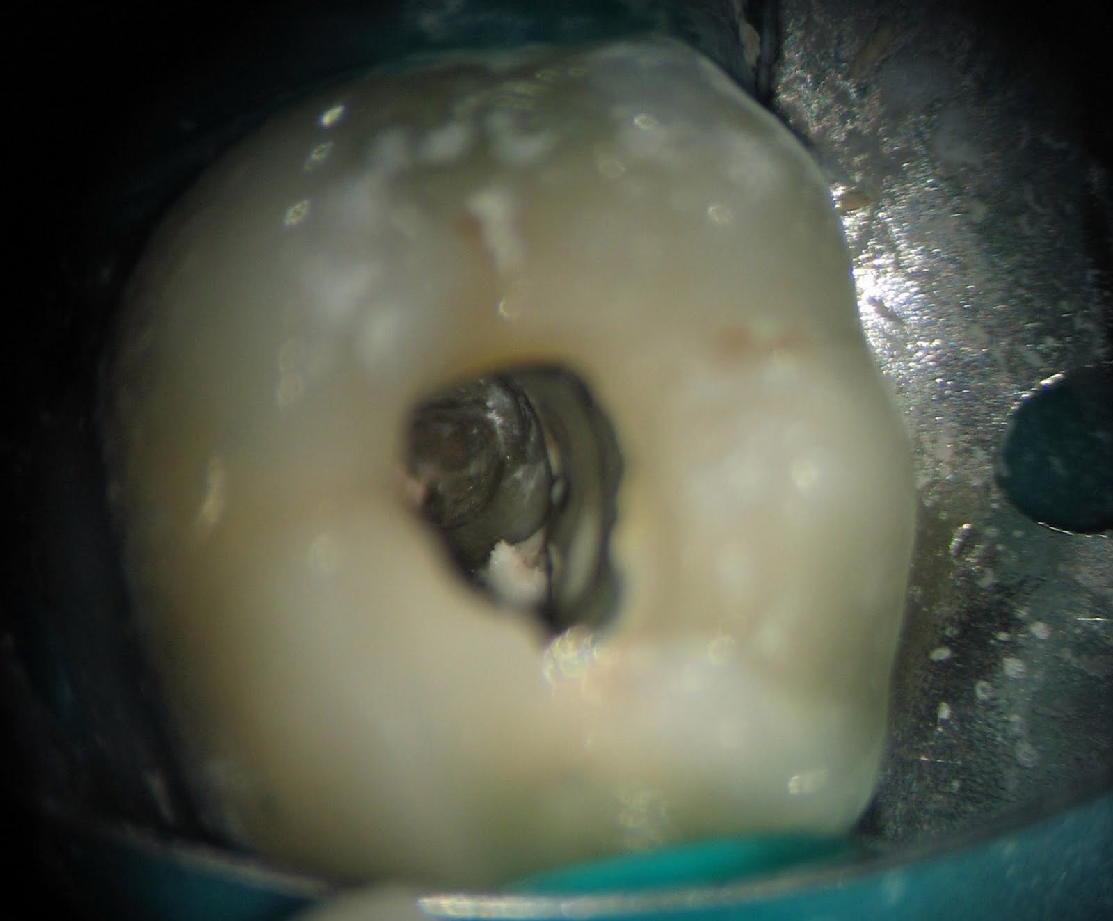 Clinical Clues for Identifying Cracked/Fracture Roots