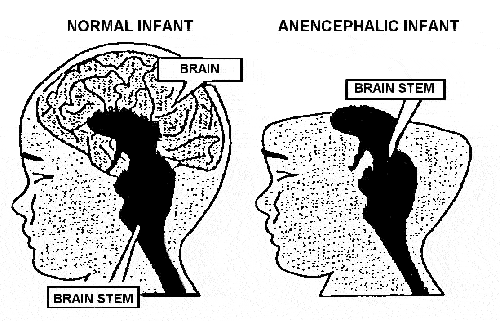 Lean Fontain Franco: Anencefalia