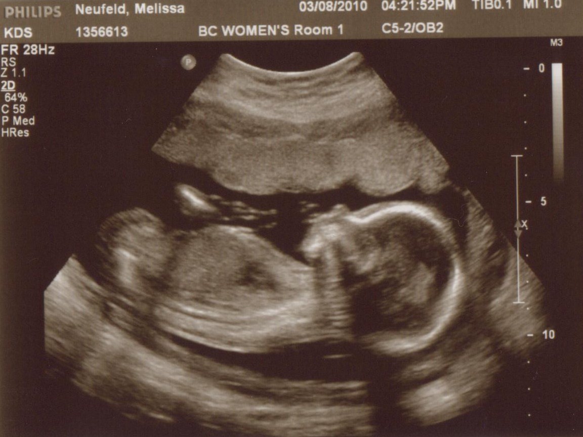 The Neufelds: 19 Week Ultrasound