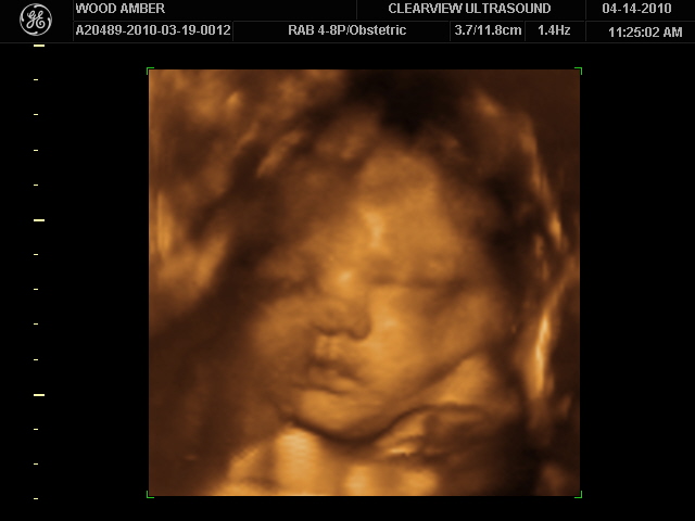 The Wood Family: 3D Ultrasound at 33 weeks