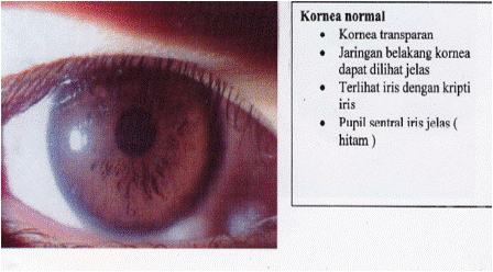 butiraN impiaN Ni aeNi......: Ulkus Kornea e.c Jamur