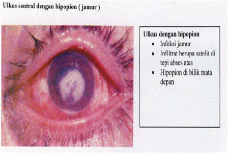 butiraN impiaN Ni aeNi......: Ulkus Kornea e.c Jamur