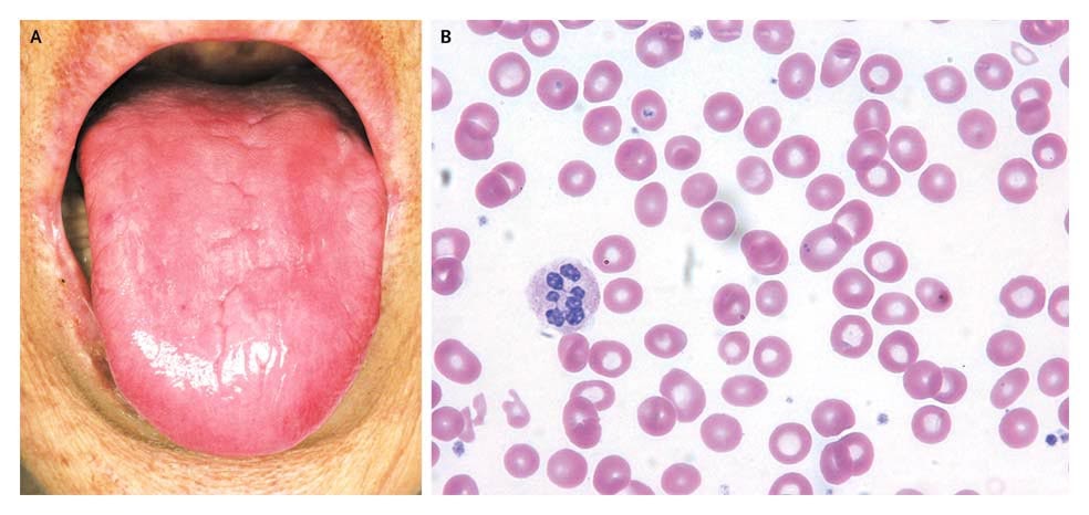 El Blog de Ernesto: la imagen de NEJM: Una lengua lisa y brillante
