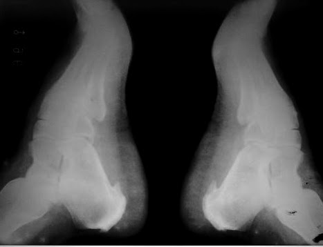 Vida y Salud Natural: Terapias alternativas: Espolón calcáneo (Dra ...