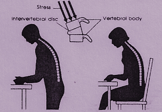 Techie Surgeon: Back pain and posture.