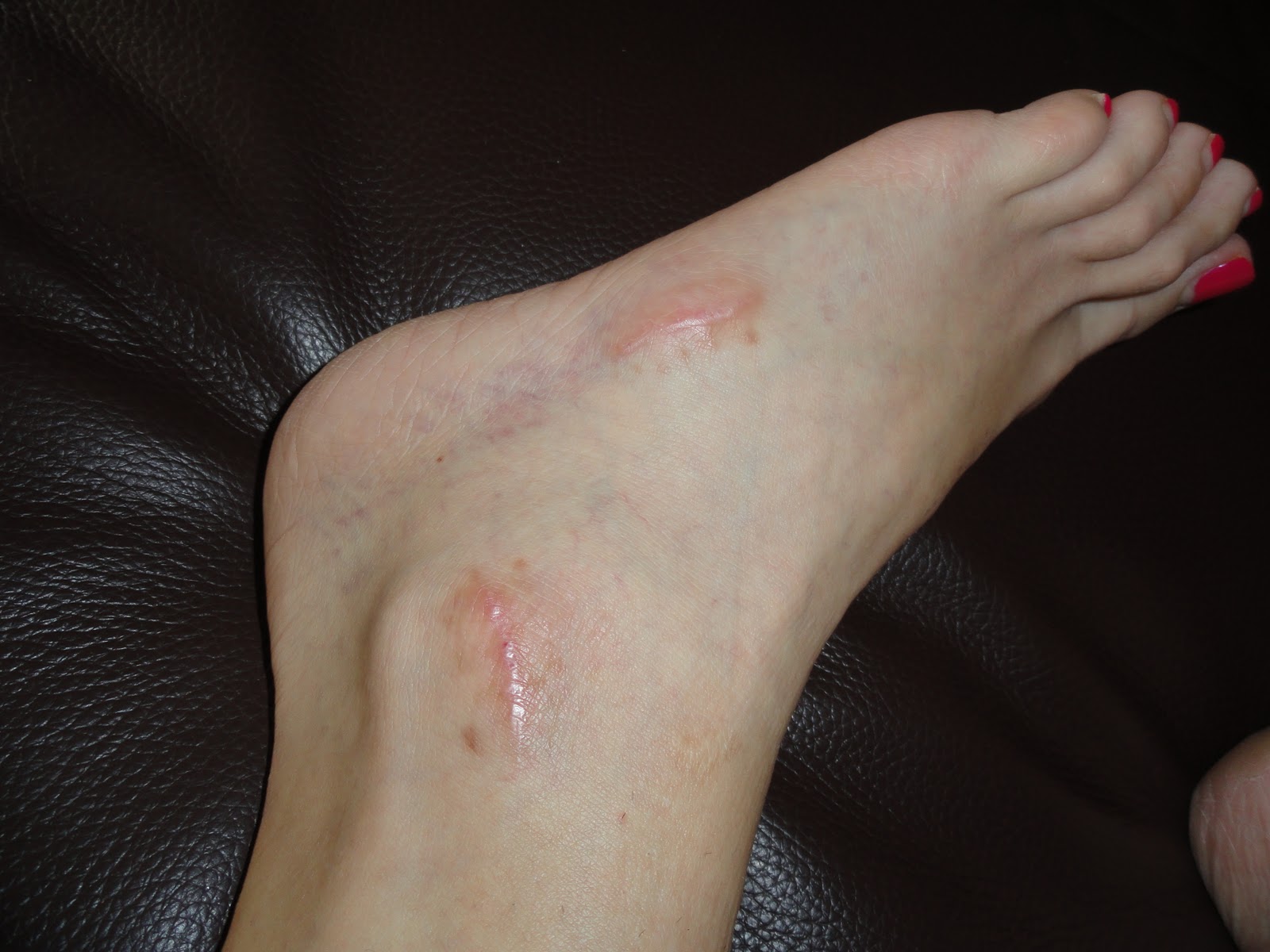 Team Bruns Blog: Update on the foot/ankle... Four Months