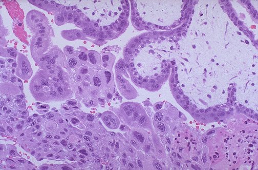 Liga de Patologia - UFC: DOENÇA TROFOBLÁSTICA GESTACIONAL (DTG)