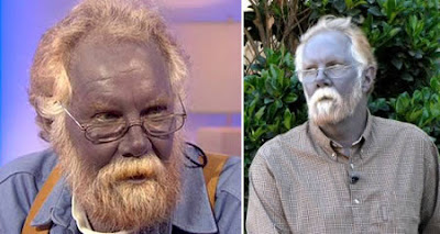 Amazing Wonders: Argyria: Blue Skin, a real-life Smurf