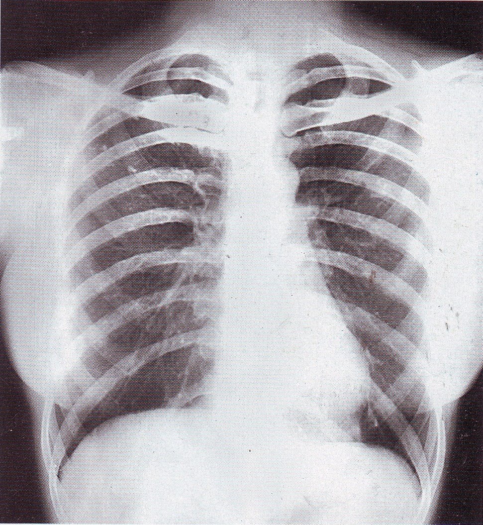 AKHSANUR BLOG'S: TEKNIK RADIOGRAFI THORAX
