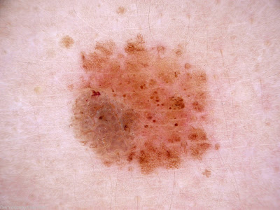 Dermoscopy Atlas: Clark nevus and Seb K