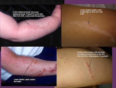 Differential Diagnosis in Dermatology: Linear lesions