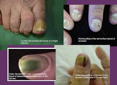 Differential Diagnosis in Dermatology: Nail problems