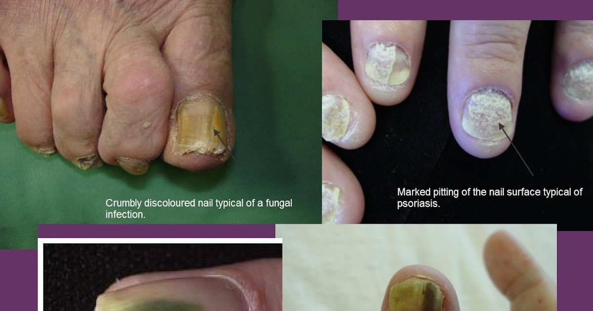 Dermatology Made simple: Nail problems