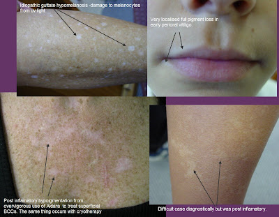 Differential Diagnosis in Dermatology: White skin localised