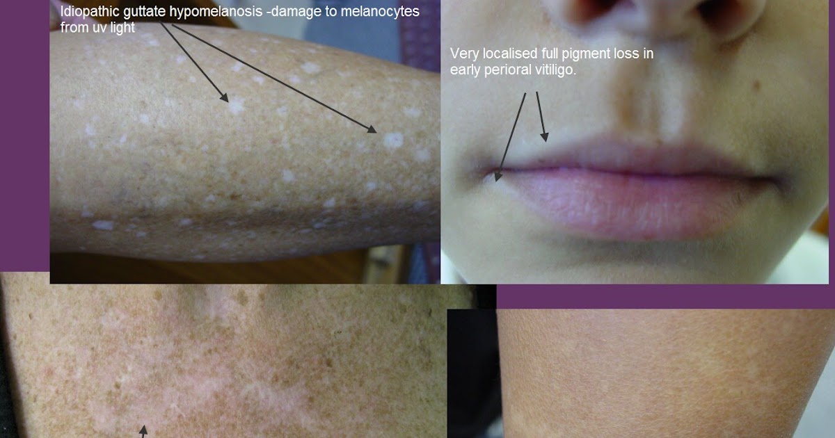 Differential Diagnosis in Dermatology: White skin localised