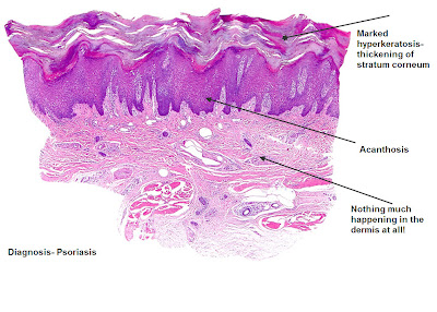 Teaching Dermatopathology: 9. Epidermal Patterns- Psoriasiform