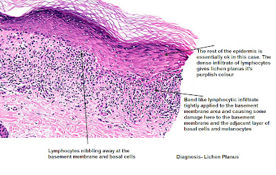 Teaching Dermatopathology: 12. Dermal Lichenoid pattern