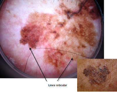 Dermoscopy Made Simple: Lines