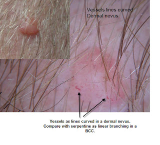 Dermoscopy Made Simple: Vessels