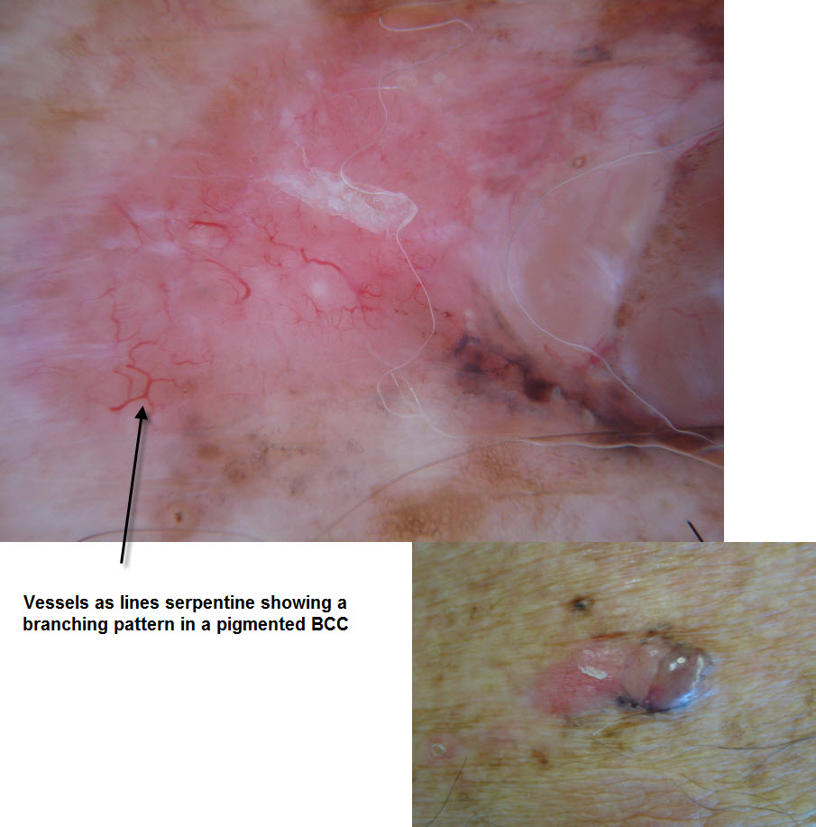 Dermoscopy Made Simple: Vessels