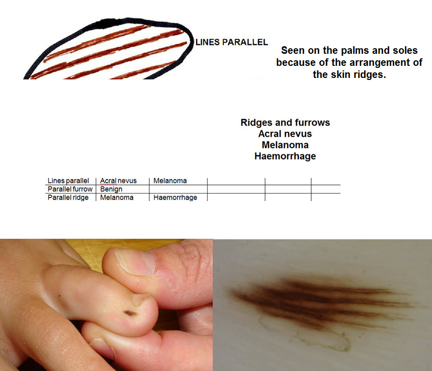 Dermoscopy Made Simple: Lines