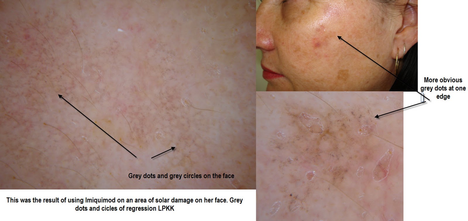 Dermatoscopy Made Simple: LPLK