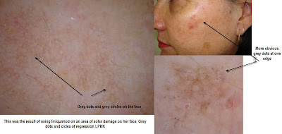 Dermoscopy Made Simple: LPLK