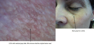 Dermoscopy Made Simple: LPLK