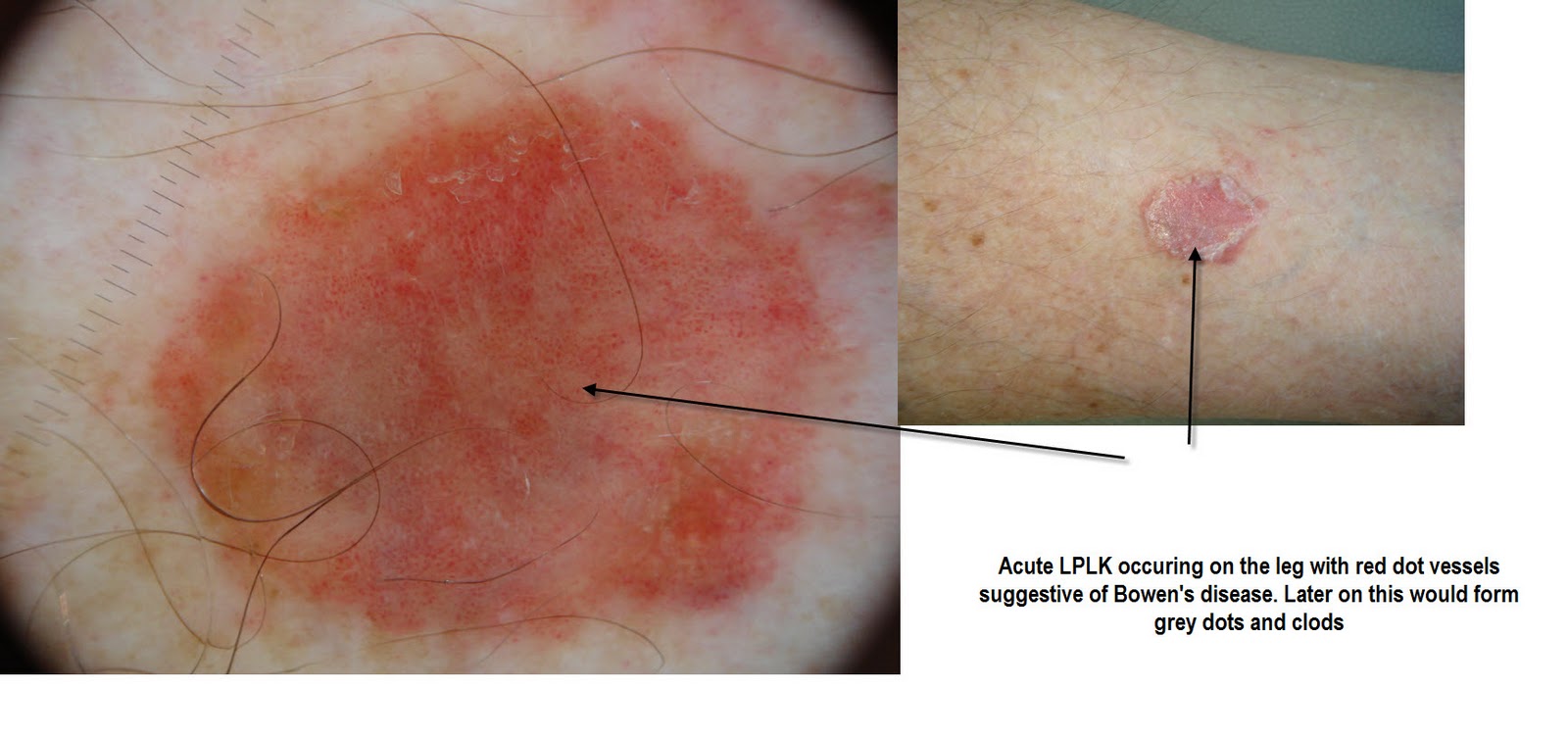 Dermatoscopy Made Simple: LPLK