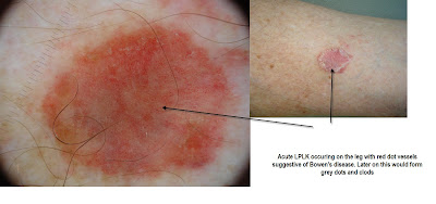 Dermoscopy Made Simple: LPLK